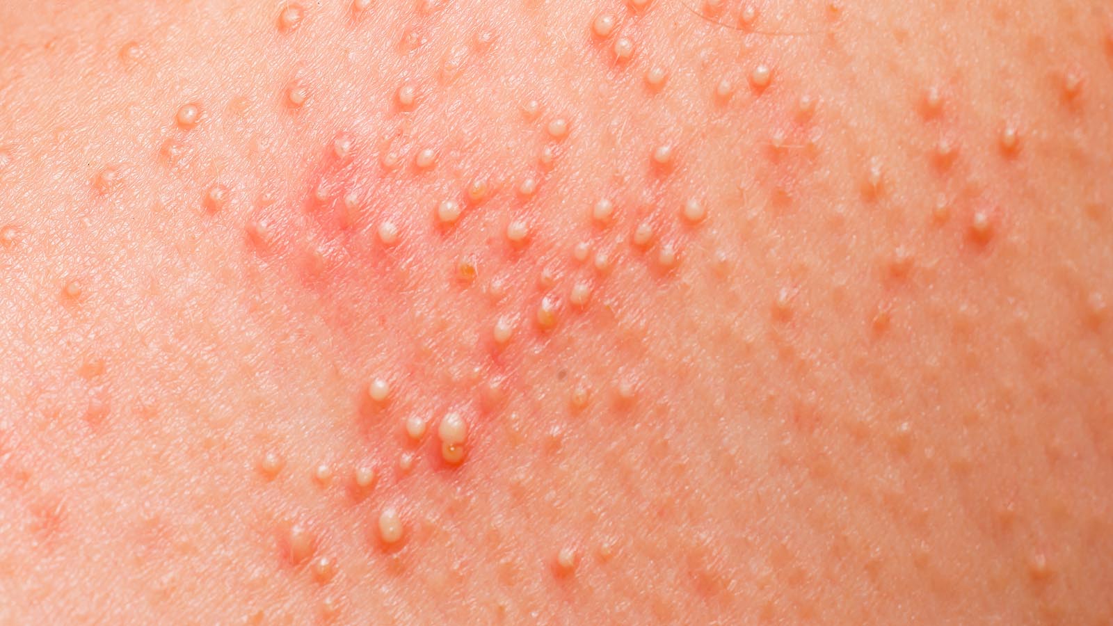 Skin Reactions - Association of Aesthetic Laser Professionals